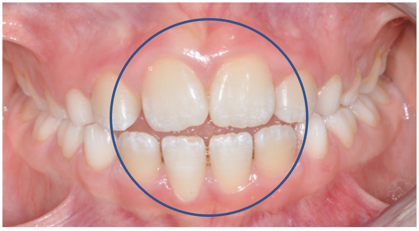 Trattamento del Palato Stretto nei Bambini: Sintomi e Soluzioni